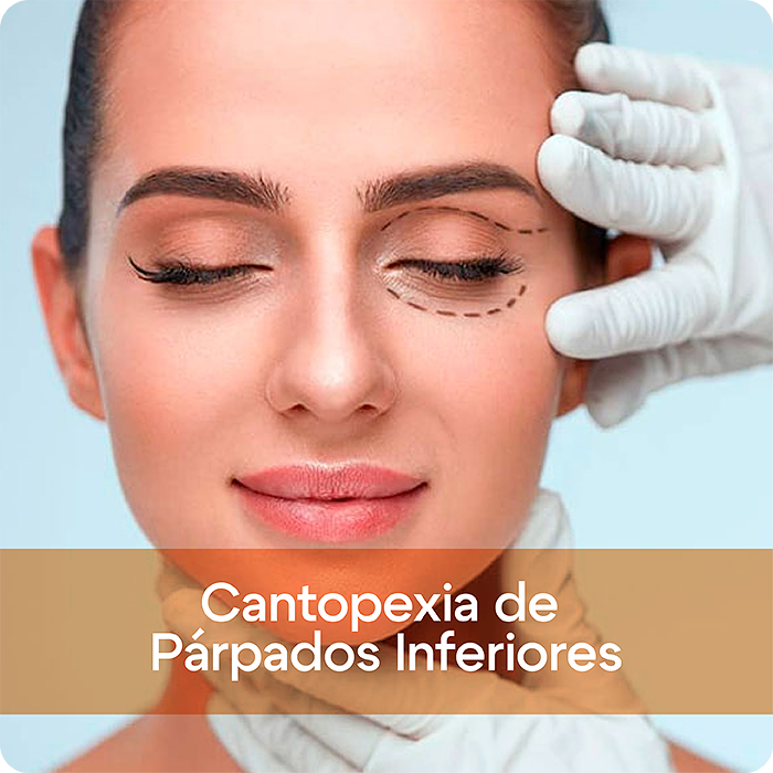 Cantopexia de Párpados Inferiores – Esteticaplast